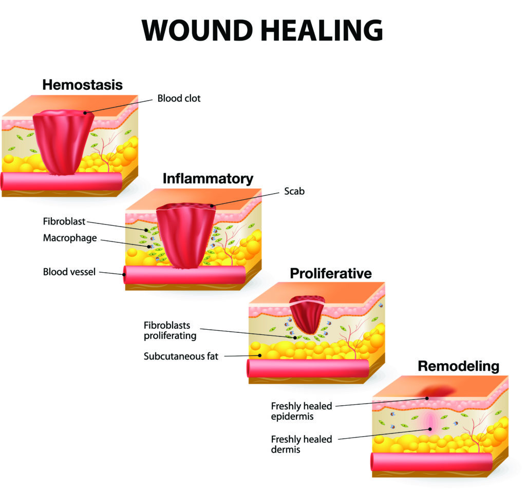 Seamless Healing: Color-Reveal Nano Wound Dressings- NO for Unwrapping ...